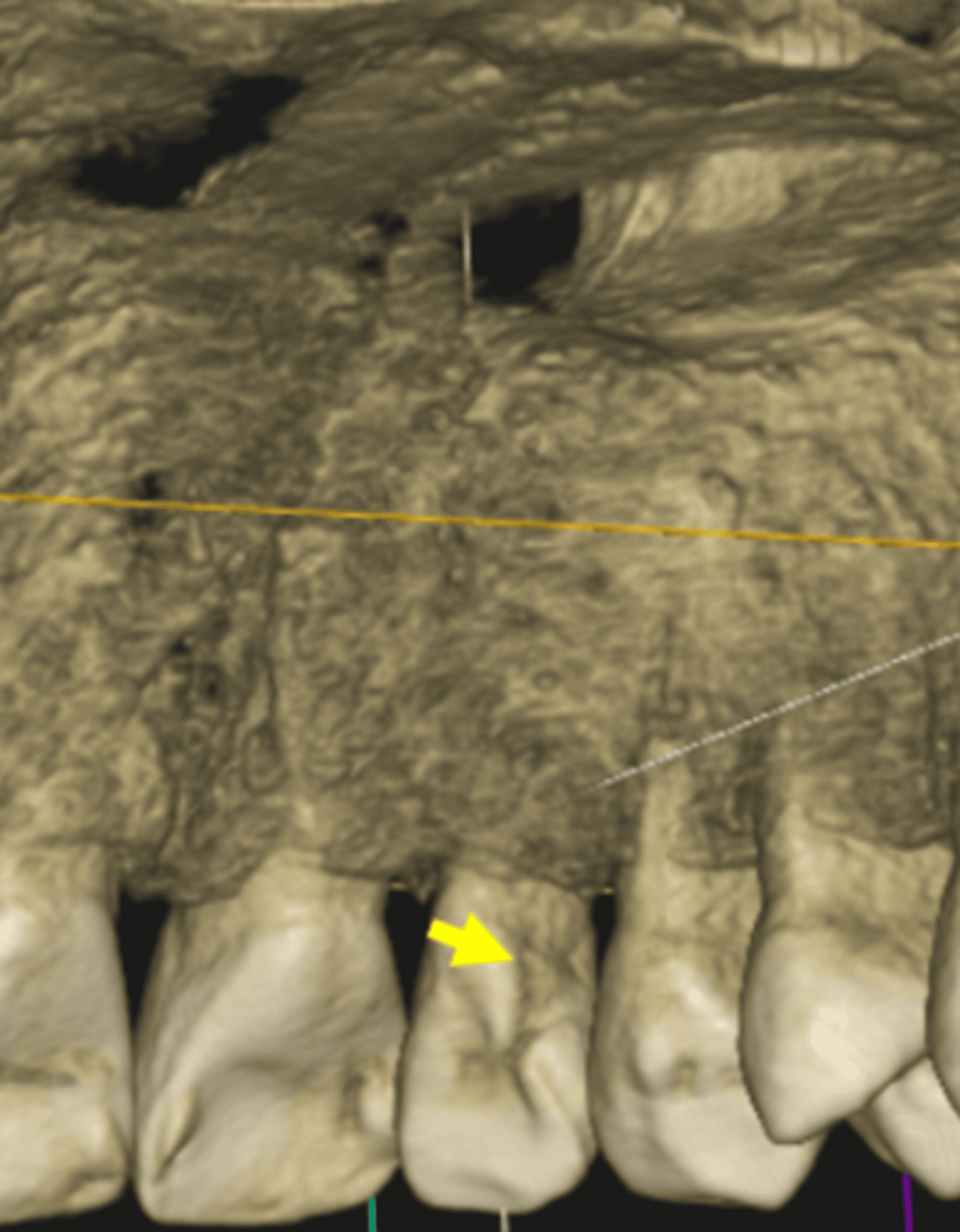 A Three-Dimensional Assessment of a Type I Shallow Palatogingival ...