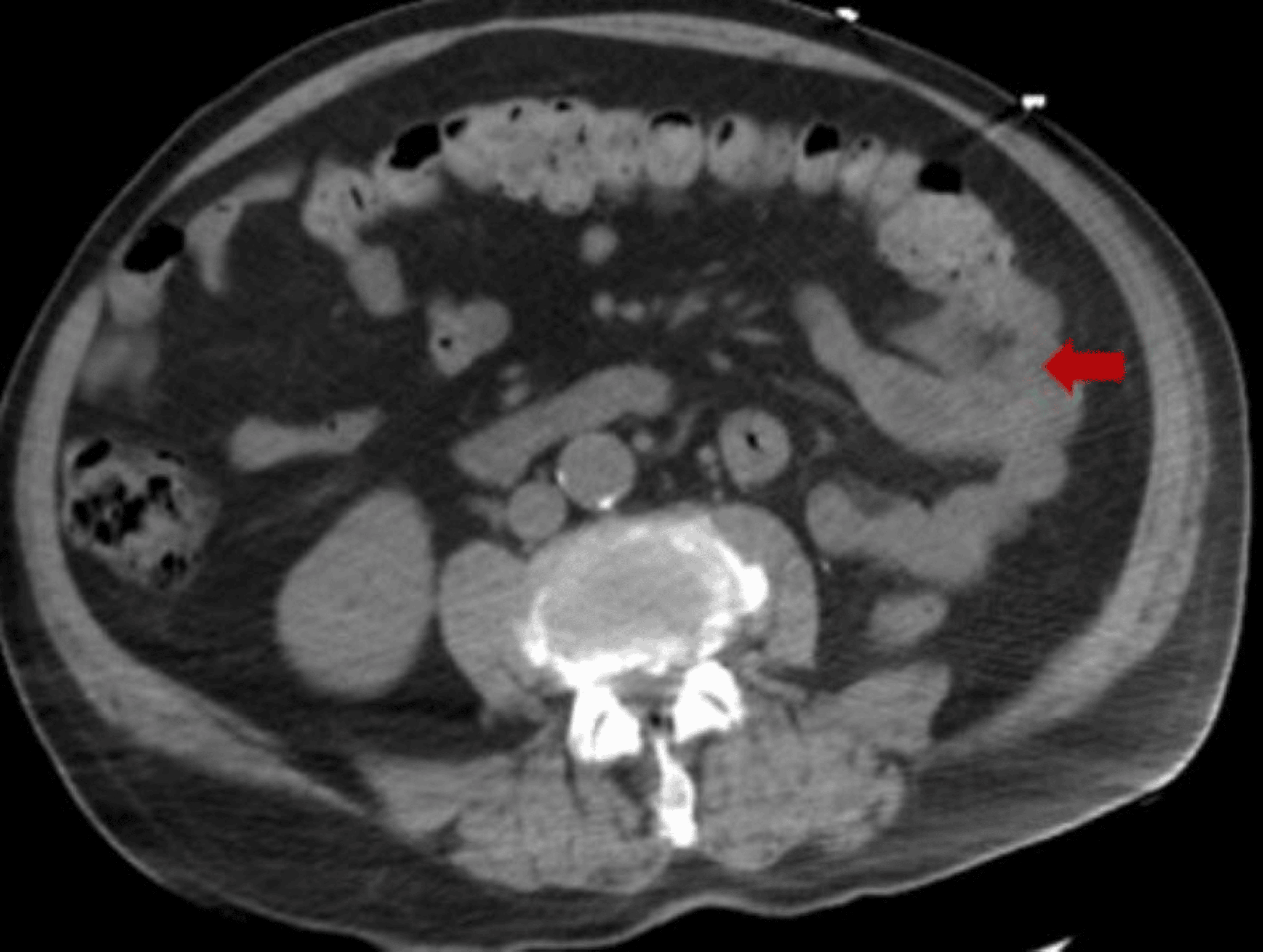 Descending Colon Metastasis of Renal Cell Carcinoma: An Unusual Site of ...