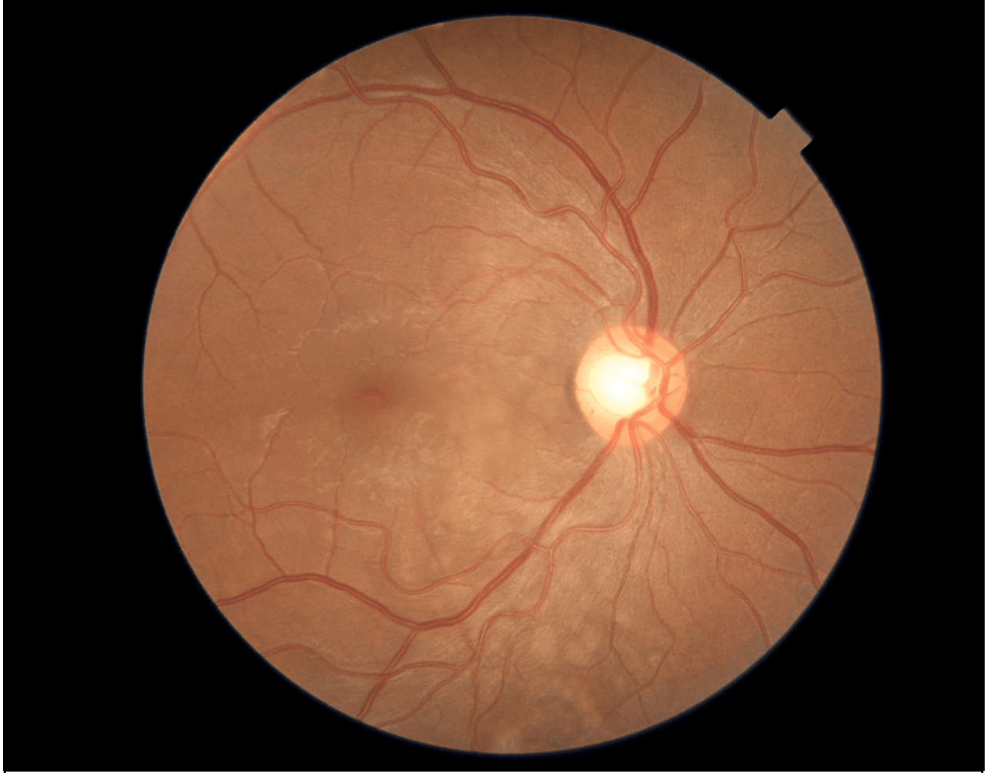 Bilateral Exudative Retinal Detachment in Preeclampsia: A Case Report ...