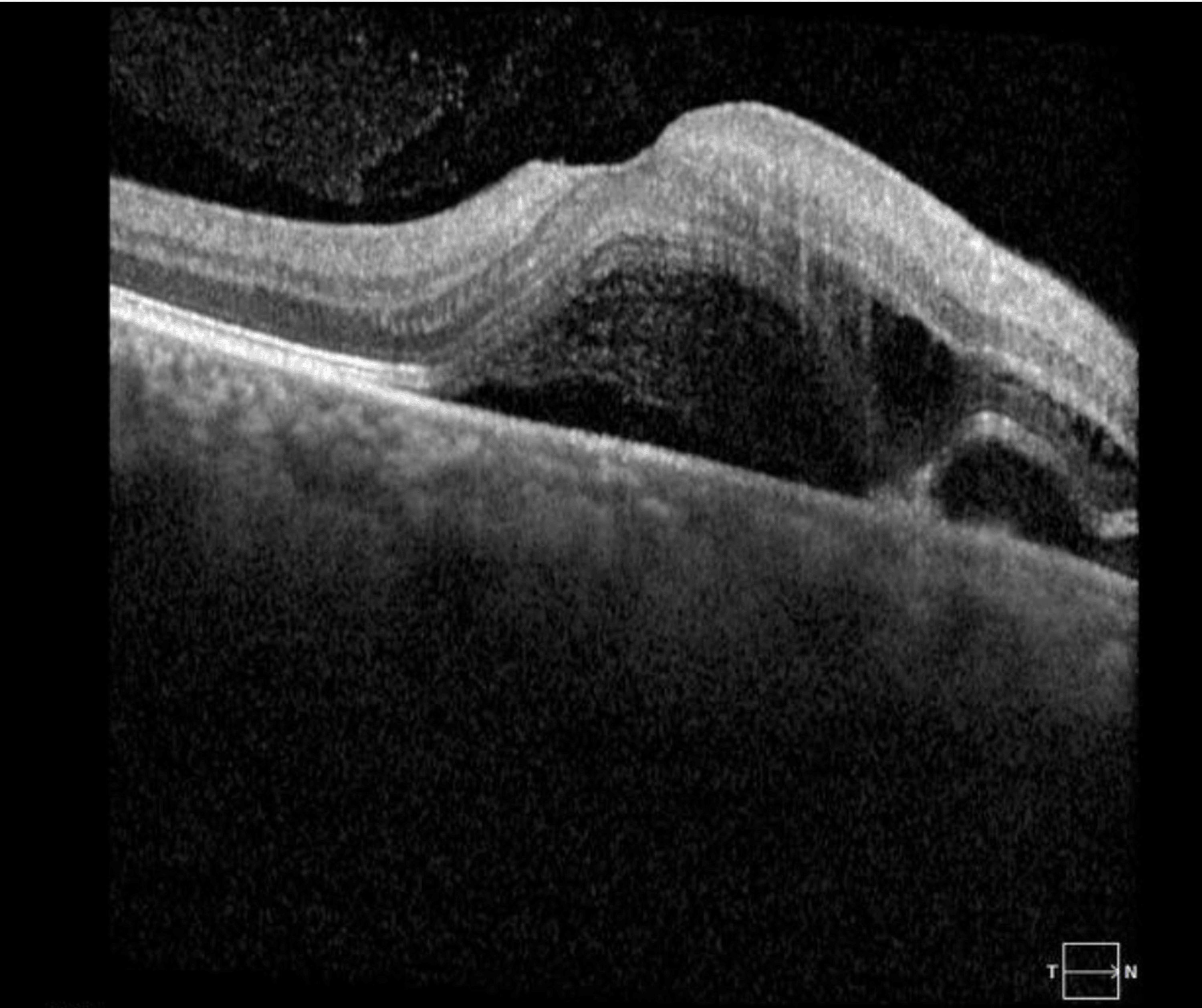 Bilateral Exudative Retinal Detachment in Preeclampsia: A Case Report ...