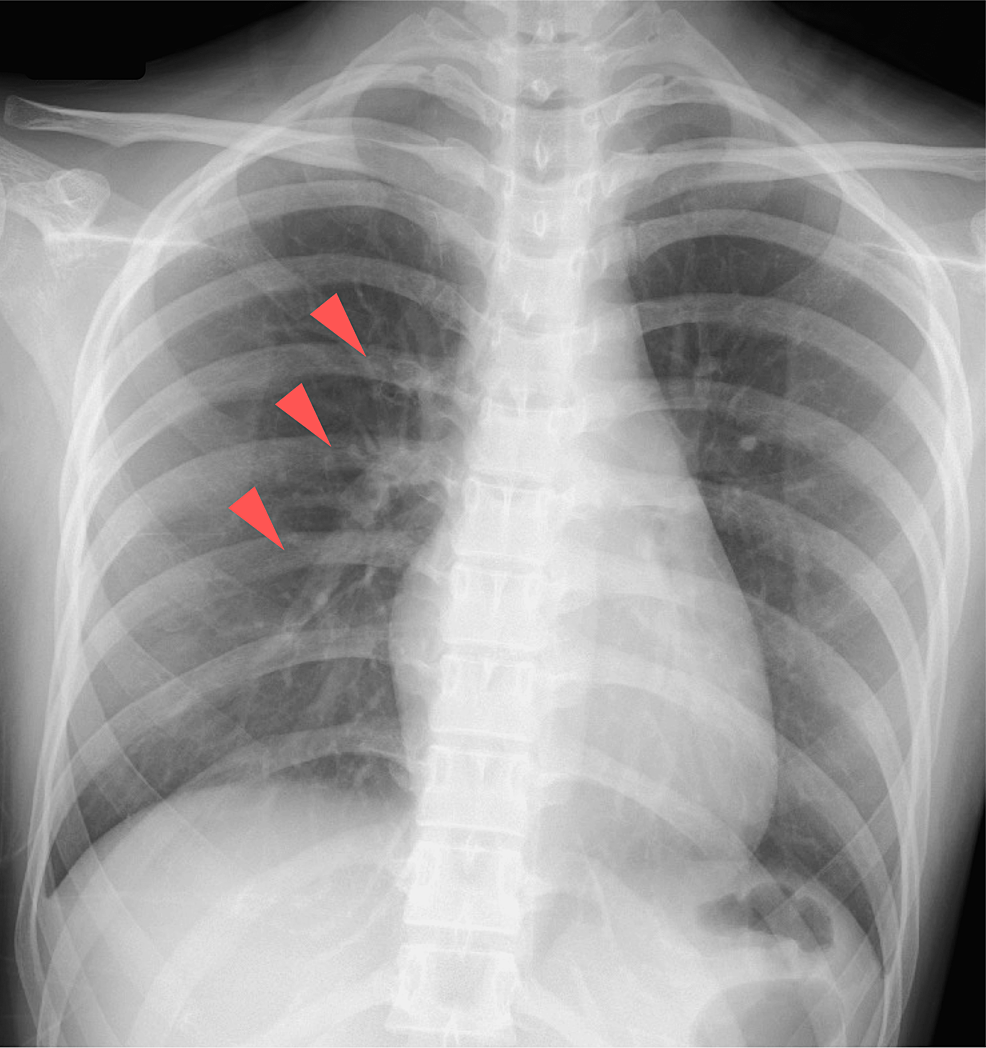 Point-of-Care Ultrasound (POCUS)-Guided Management of Cardiogenic Shock ...