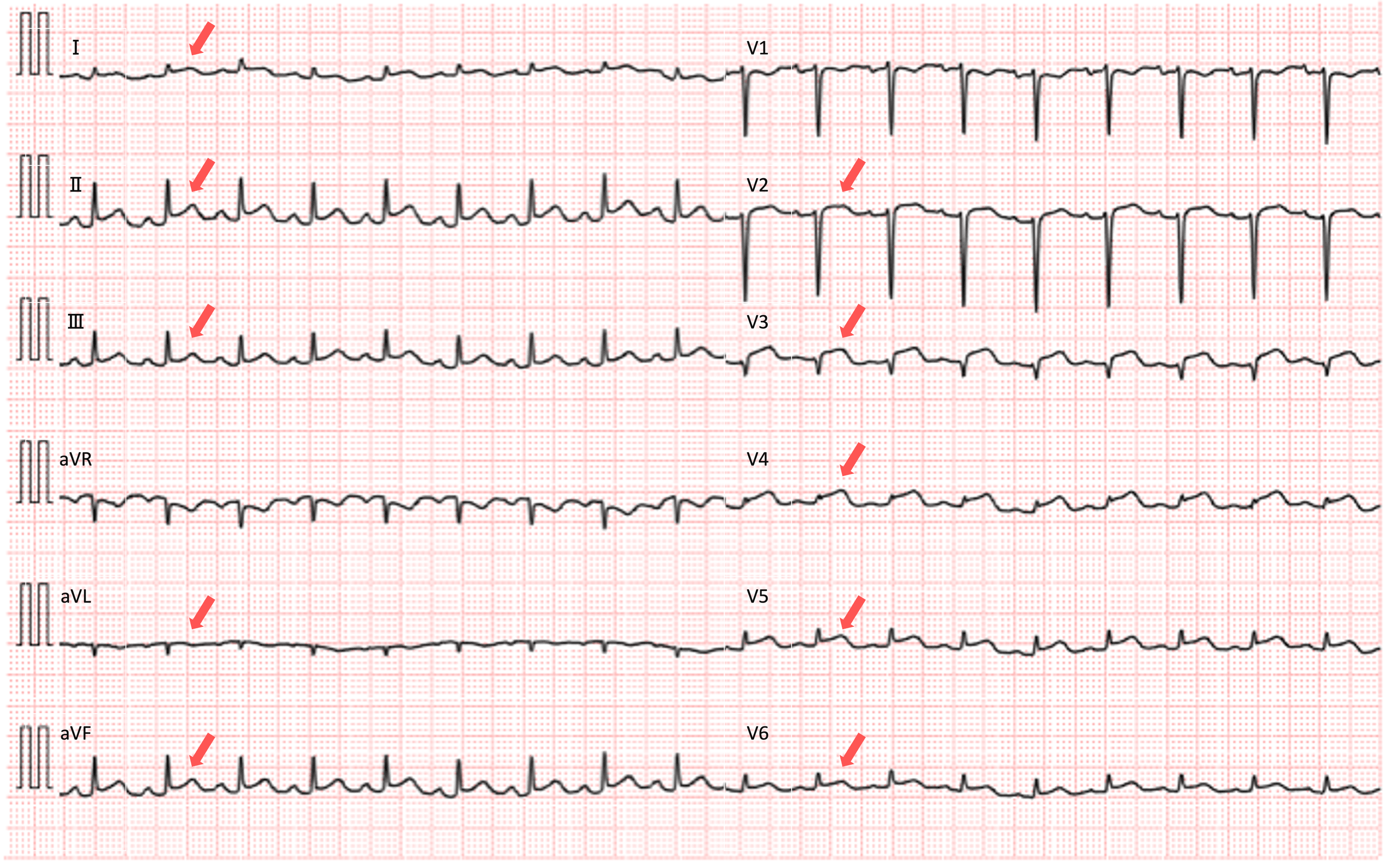 Point-of-Care Ultrasound (POCUS)-Guided Management of Cardiogenic Shock ...