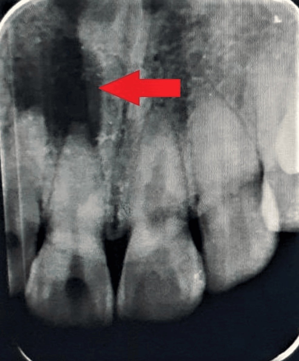 Revamping the Perished: The Management of Internal Tooth Resorption ...