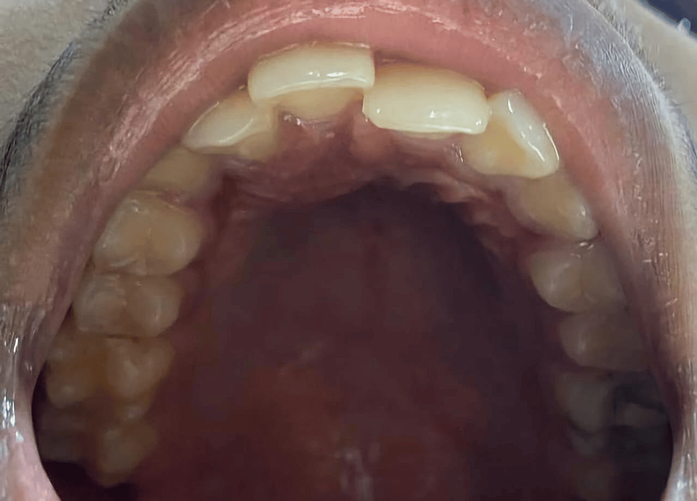 Anterior Maxillary Mesiodens Extraction in a Young Adult Male: A Case ...