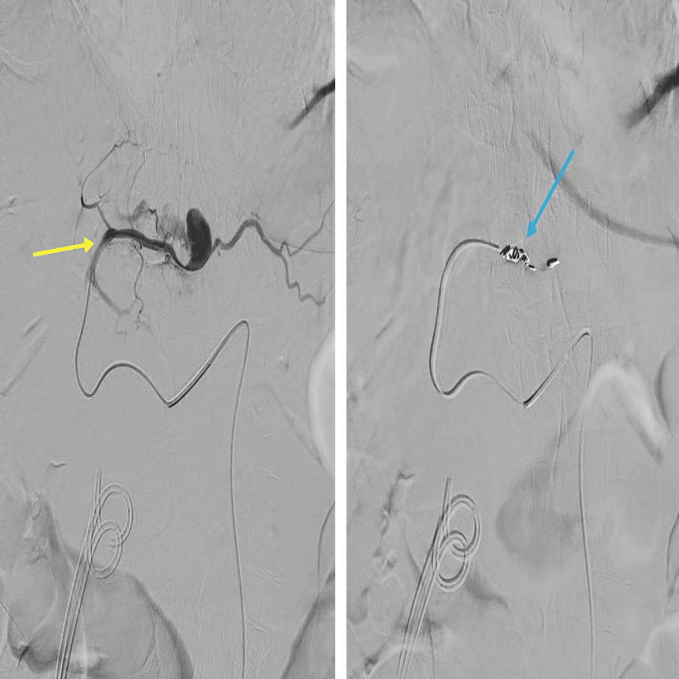The Embolization Of The Segmental Branch Of Hepatic Artery