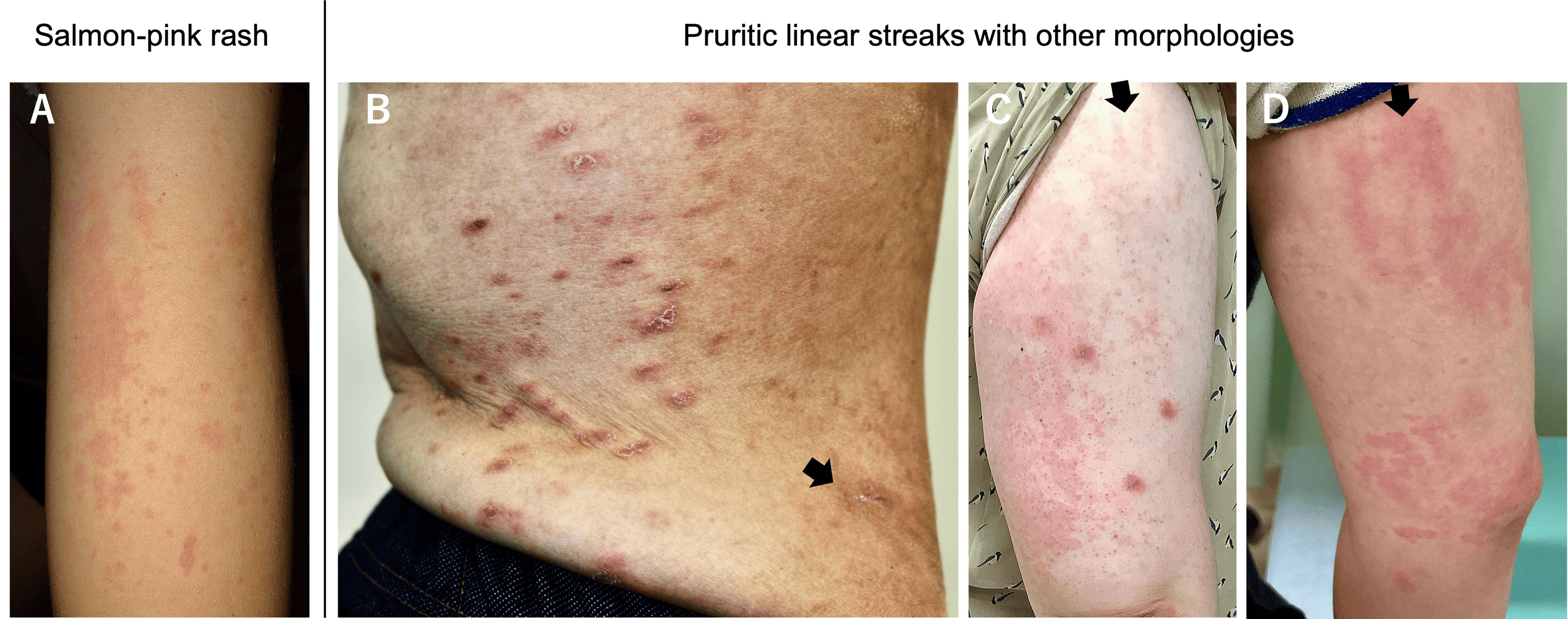 Persistent Pruritic Linear Streaks of Adult-Onset Still’s Disease ...