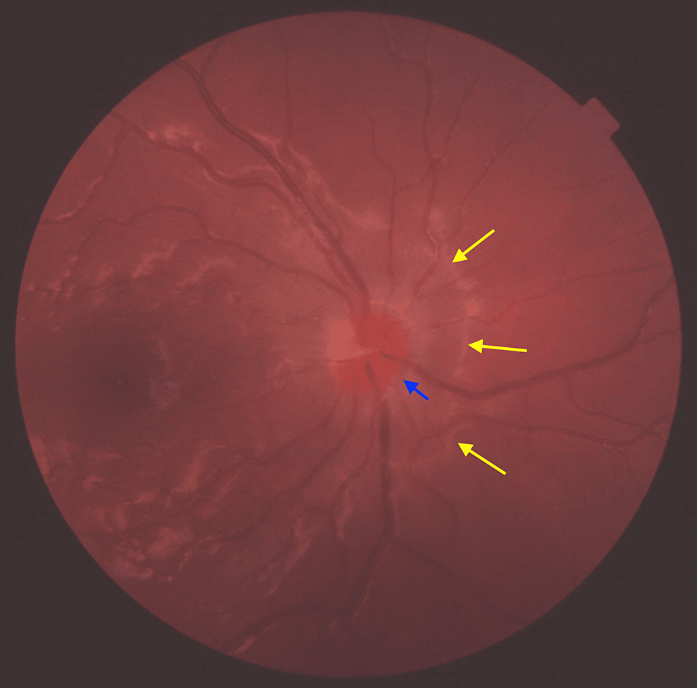 diffuse posterior scleritis