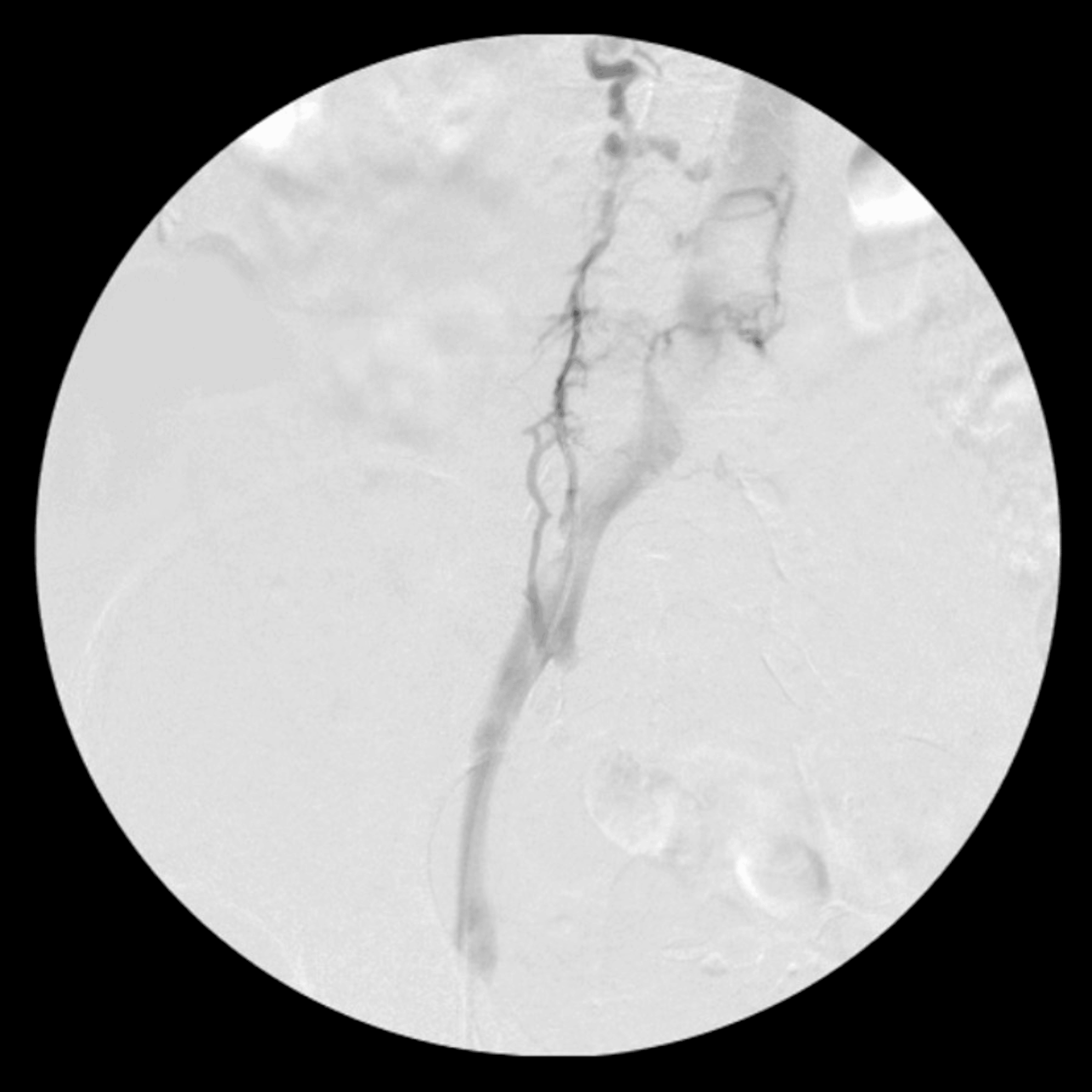 Deep Venous Thrombosis Within a Complete Duplication of the Left ...