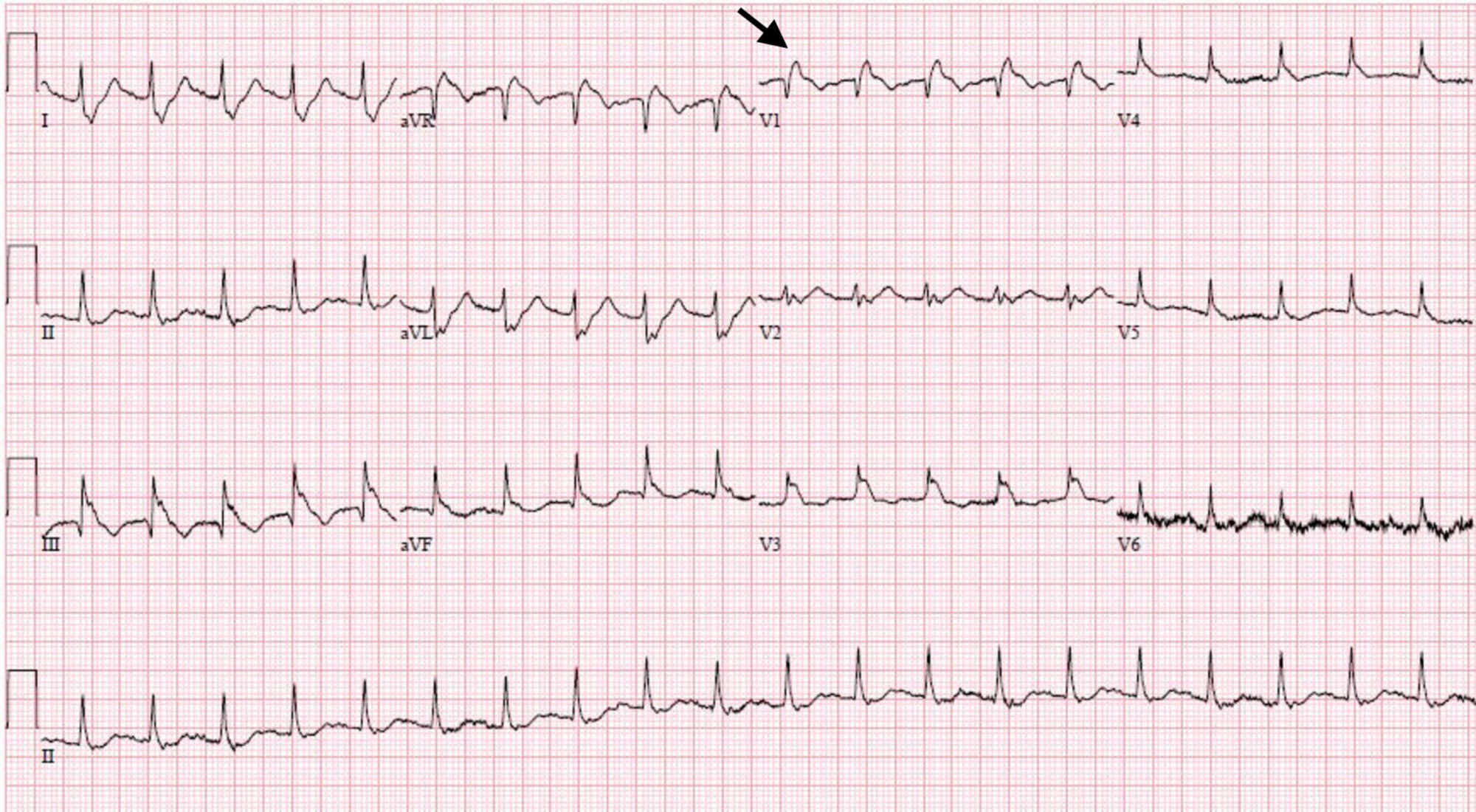 Serial Point Of Care Echocardiography Performed By An Emergency