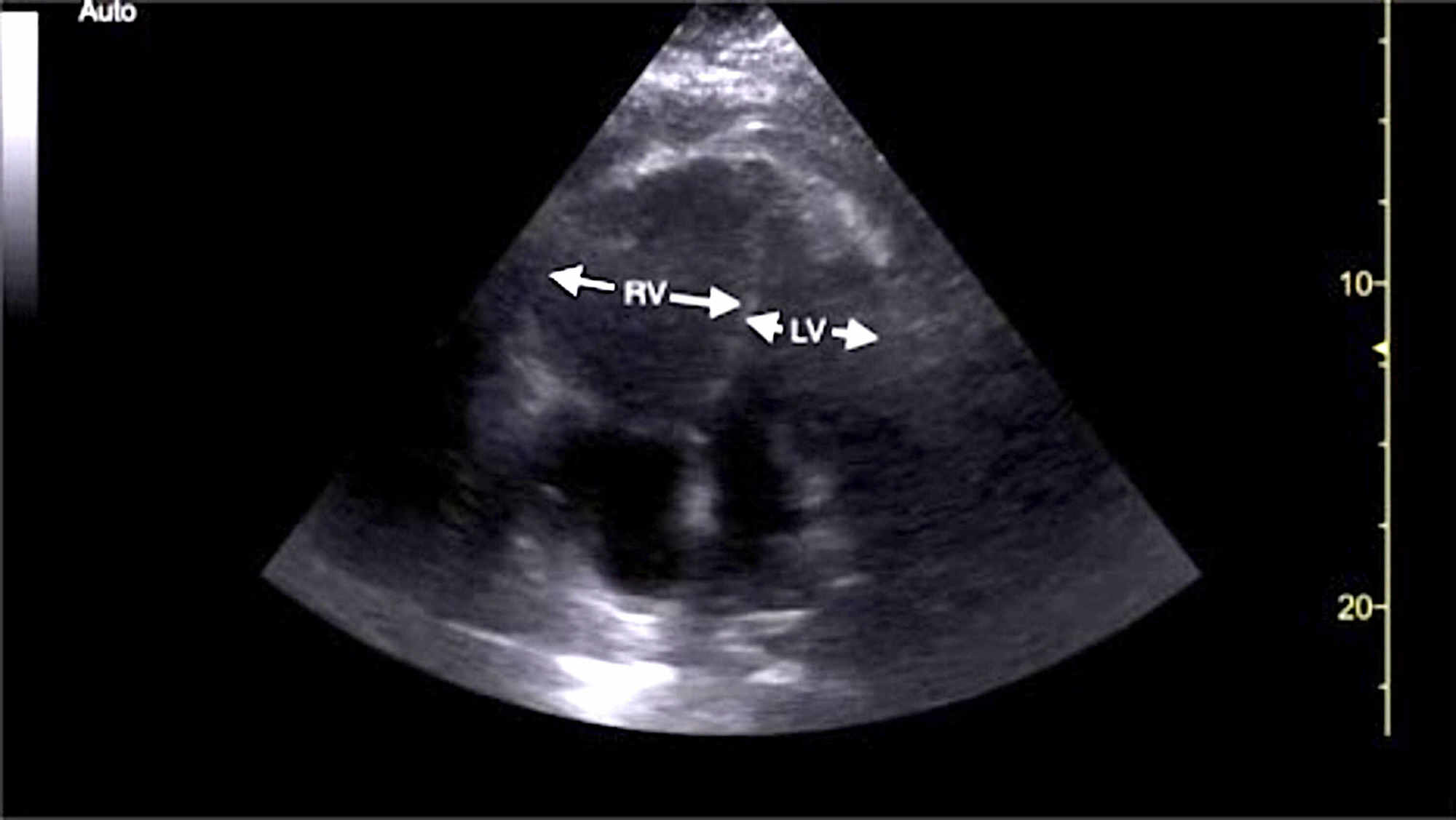 Cureus Serial Point Of Care Echocardiography Performed By An