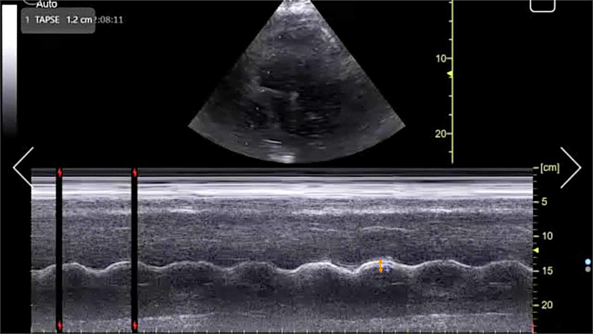 Cureus Serial Point Of Care Echocardiography Performed By An