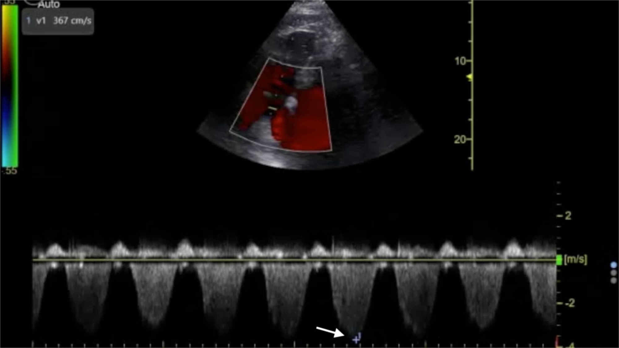 Serial Point Of Care Echocardiography Performed By An Emergency