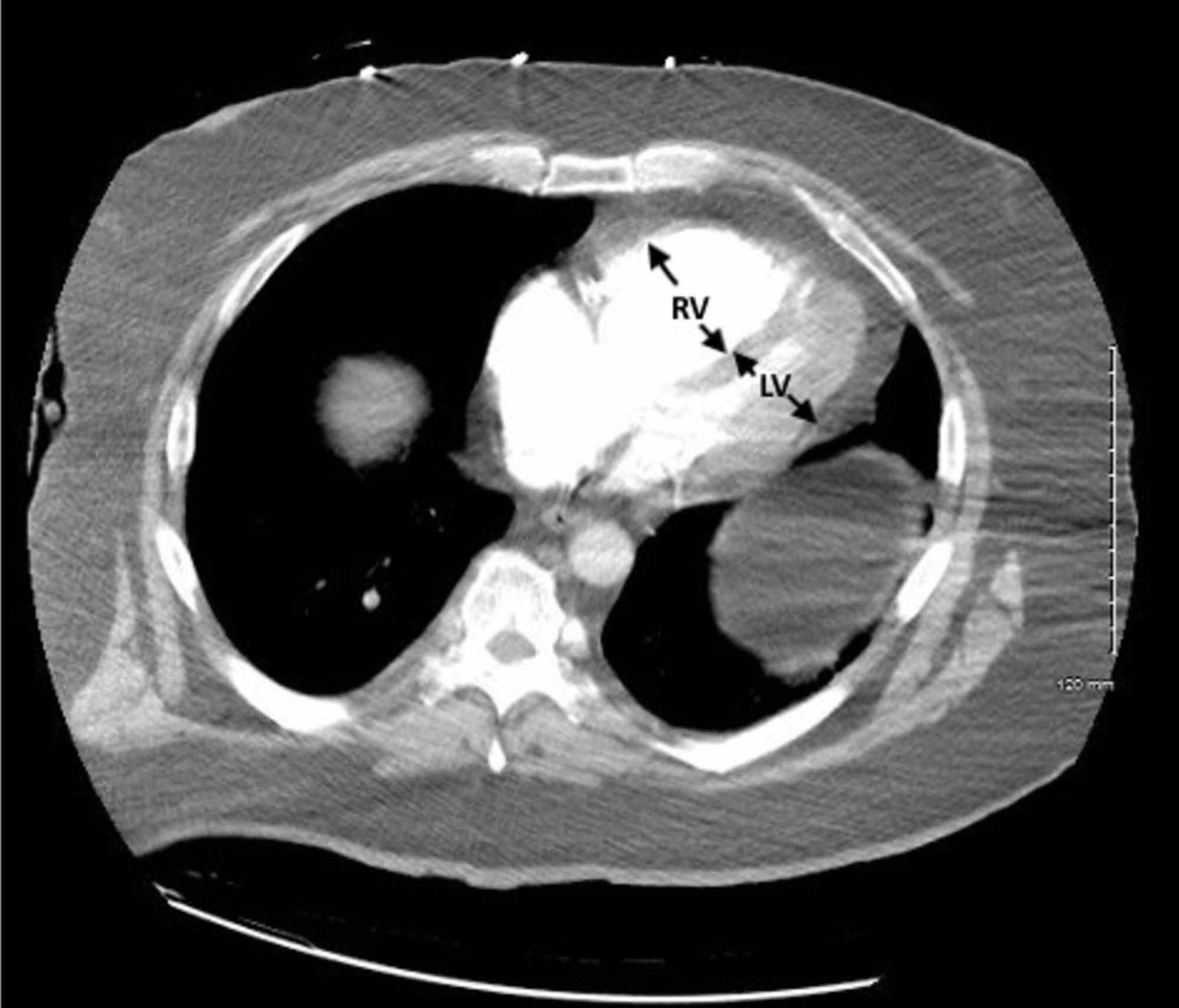 Cureus Serial Point Of Care Echocardiography Performed By An