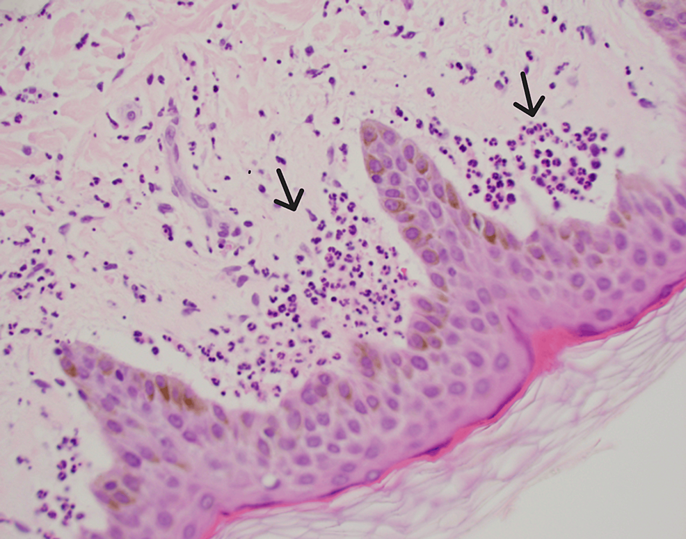 Schnitzler-Like Syndrome Presenting With IgG Kappa Monoclonal ...