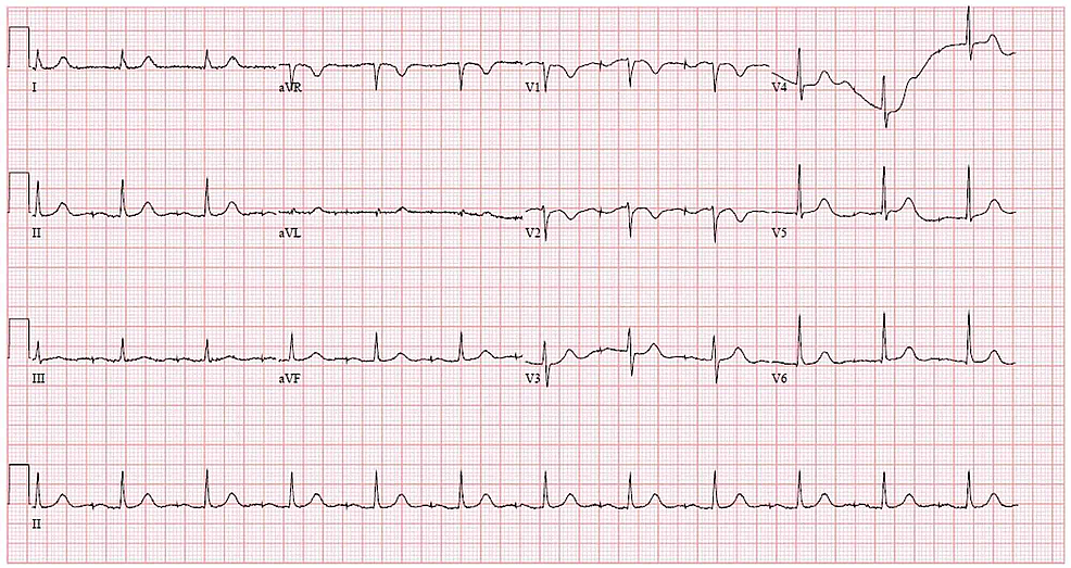 Cureus | A Case of Amiodarone Pulmonary Toxicity with Short-term ...
