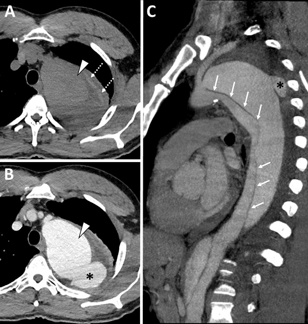 A Case Report of Type B Aortic Dissection With Ruptured False Lumen ...