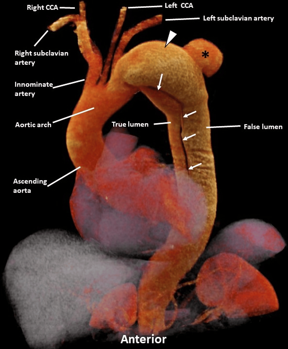 A Case Report of Type B Aortic Dissection With Ruptured False Lumen ...