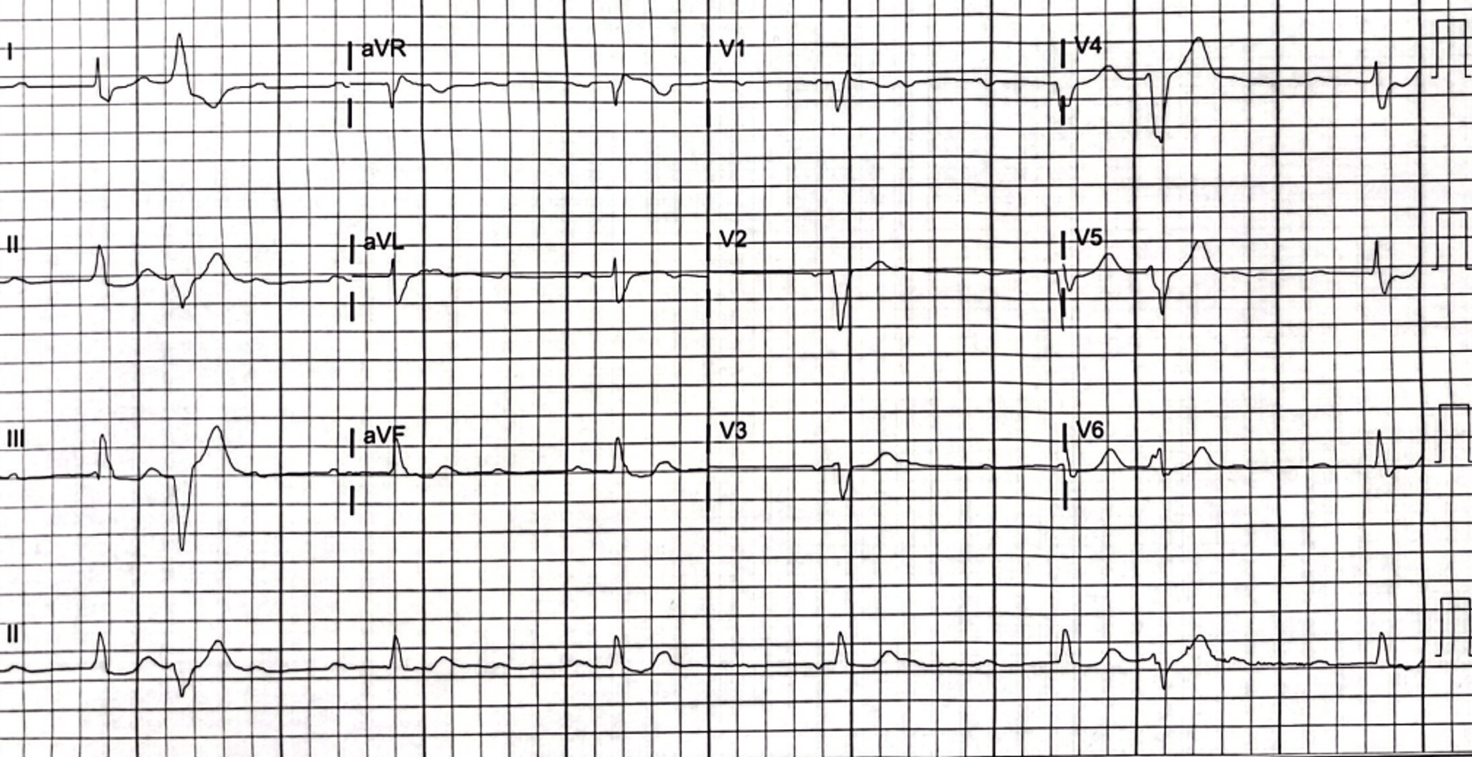 Complete Heart Block in a Patient Undergoing Combination Immune ...
