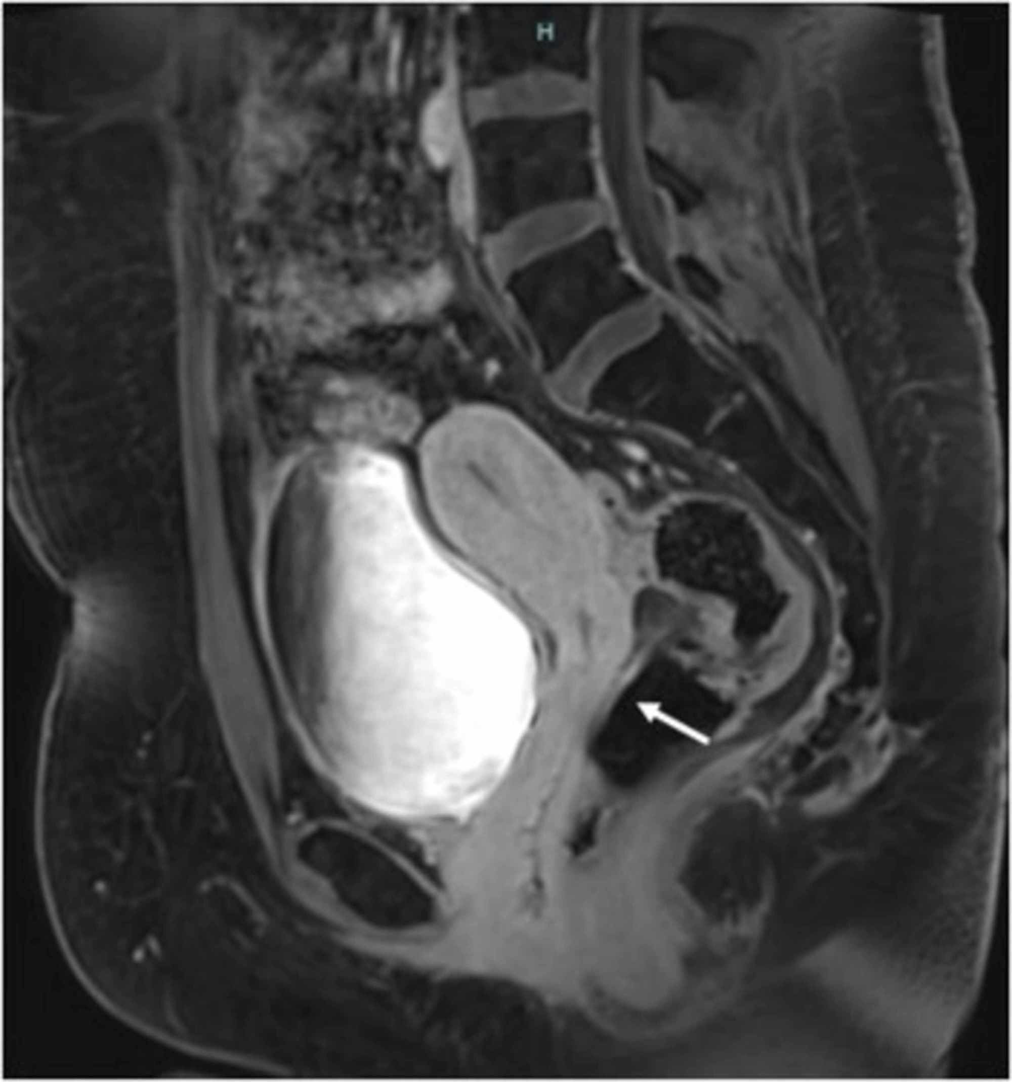 Cureus A Rare Case Of Clear Cell Adenocarcinoma Of The Cervix With No