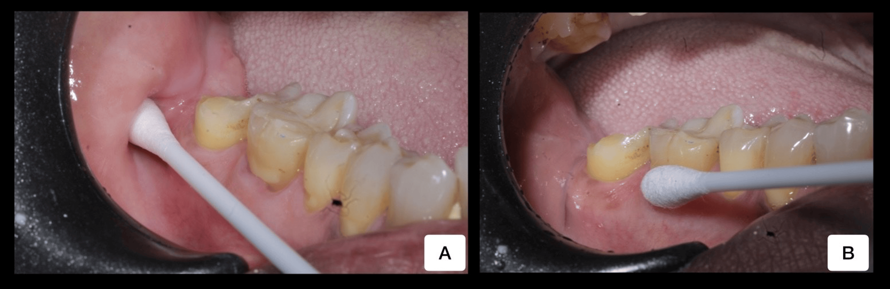 Comparative Evaluation of Microbial Adhesion on Provisional Crowns ...