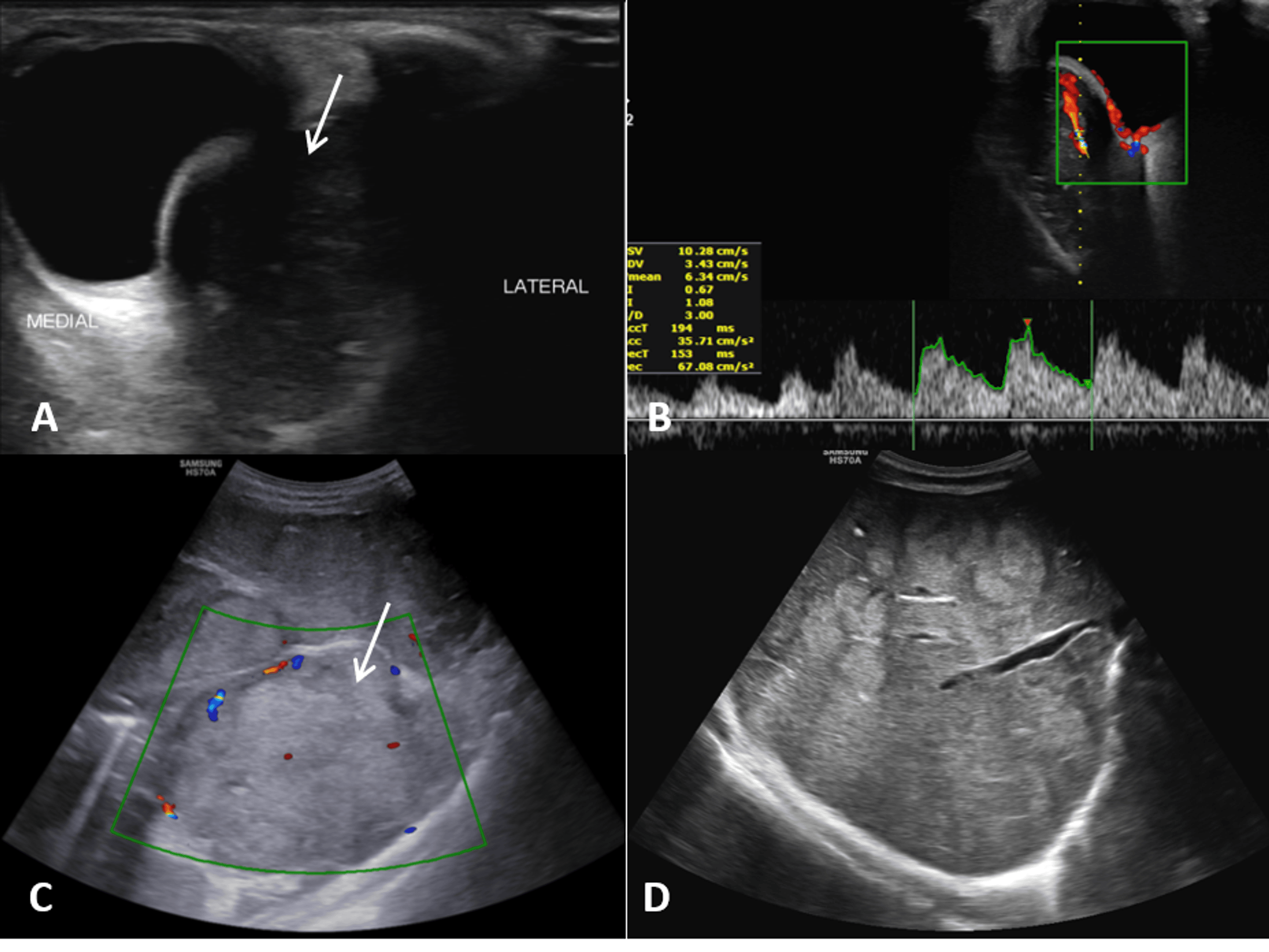 Primary Ewing’s Sarcoma of the Kidney Mimicking Renal Cell Carcinoma ...