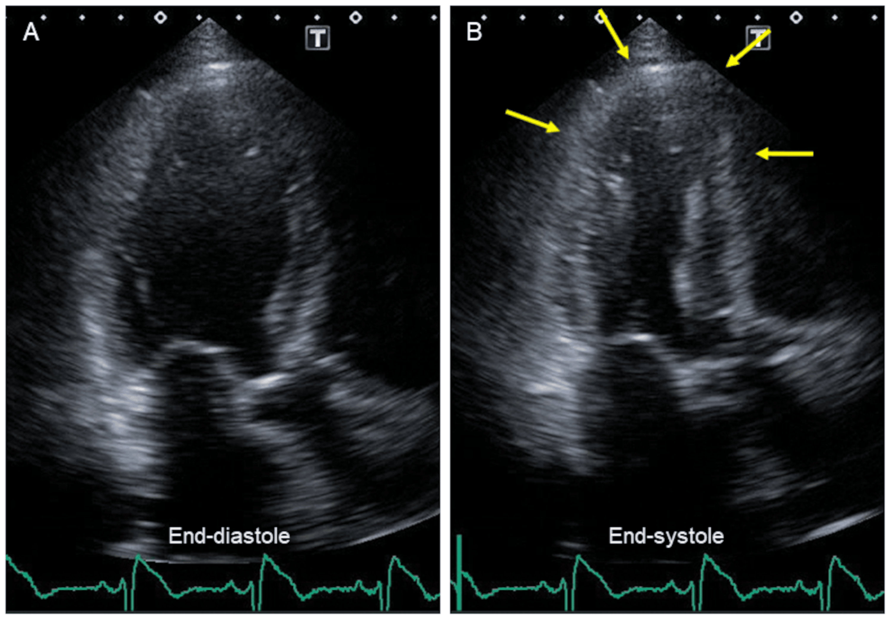 Apical Acute Myocardial Infarction Due to Occluded Posterior Descending ...