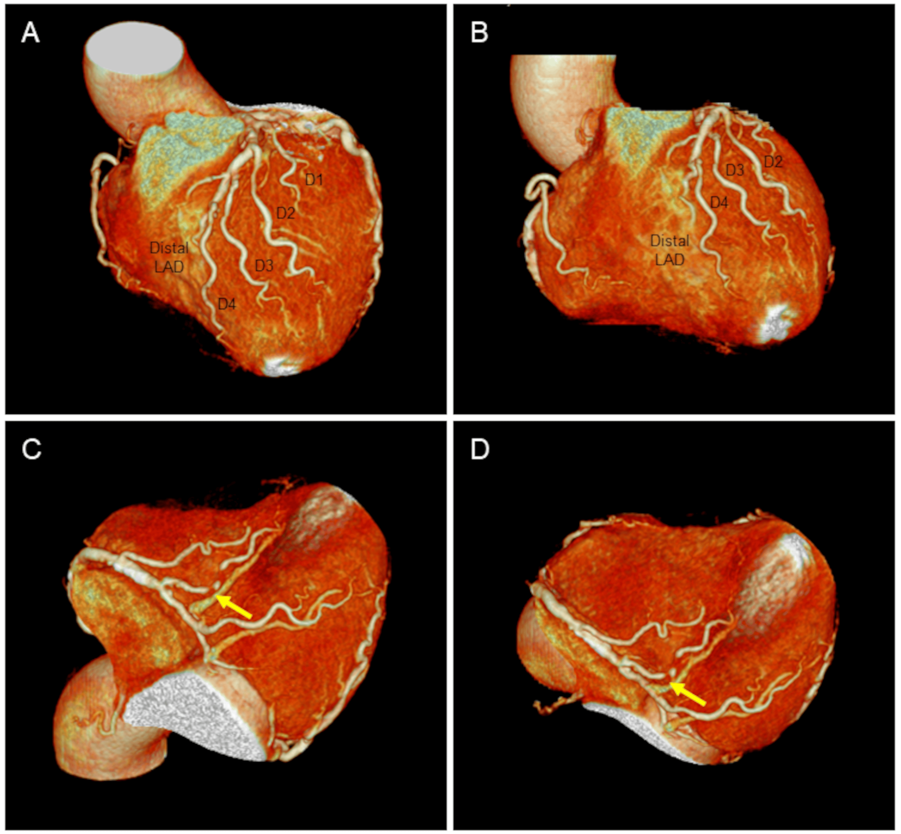 Apical Acute Myocardial Infarction Due to Occluded Posterior Descending ...