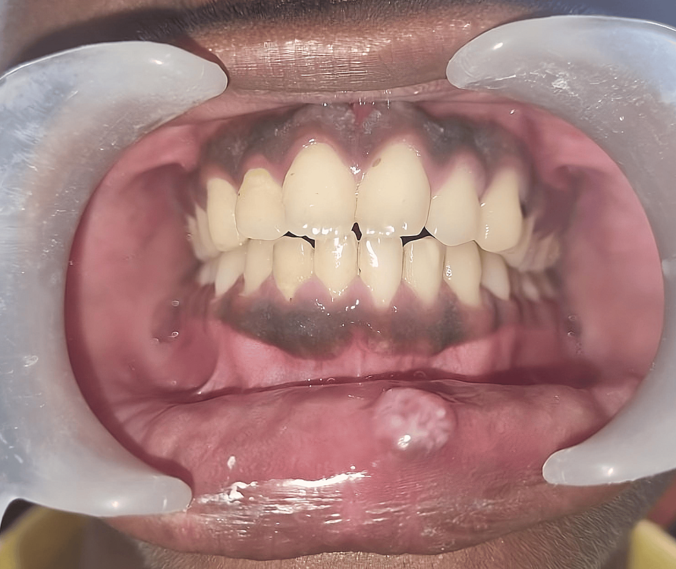 Nonsurgical Treatment of Oral Mucocele With Intralesional ...