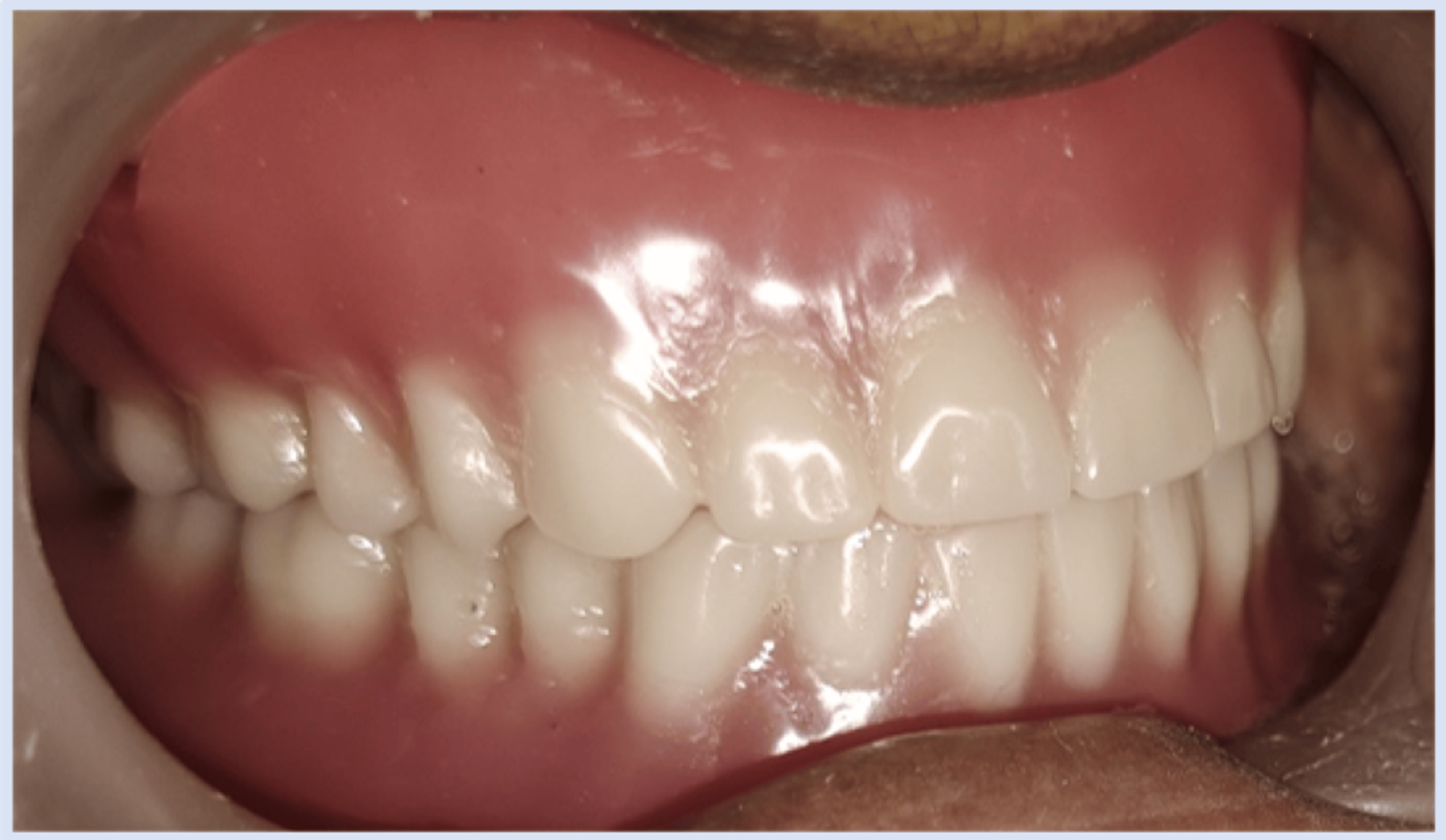 Optimizing Denture Success: A Strategy for Prosthodontic Rehabilitation ...