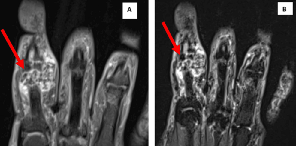 A Rare Case of Synovial Chondromatosis in the Proximal Interphalangeal ...