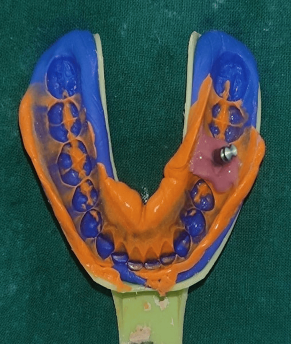 Clinical Outcomes of Single Tooth Implant Placement in the Mandibular ...