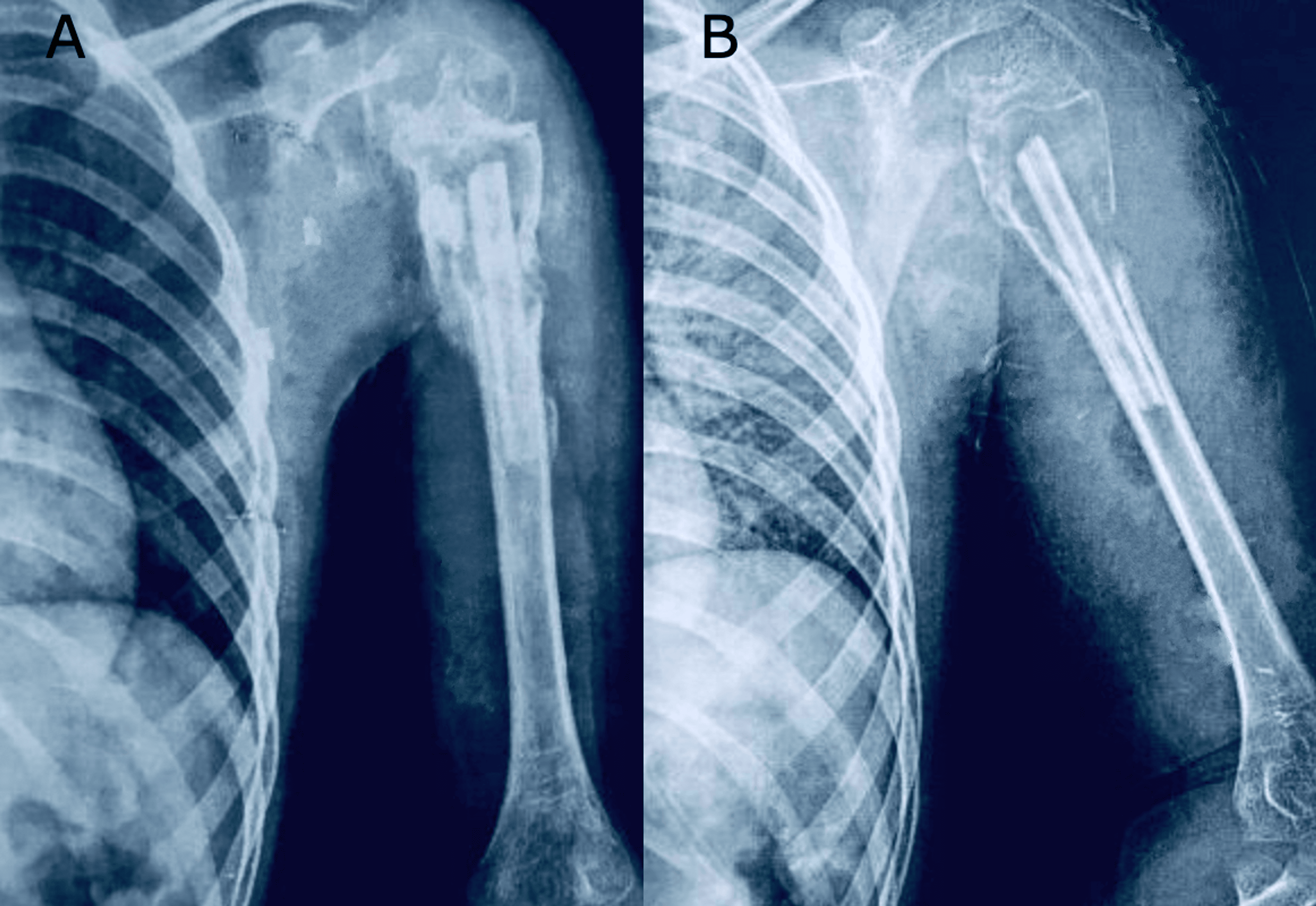 Outcomes of Non-vascularized Fibular Grafts in Proximal Humerus ...