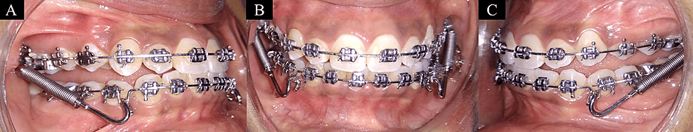 Revolutionizing Class II Division 1 Malocclusion Treatment With Forsus ...