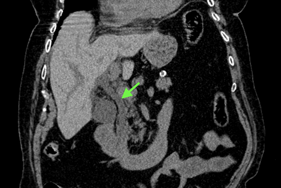Cureus | Biloma: A Rare Manifestation of Spontaneous Bile Leak
