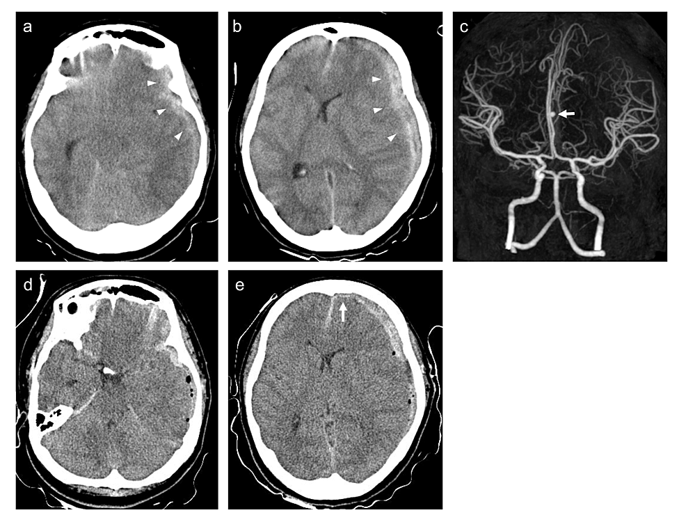 Acute Subdural Hematoma