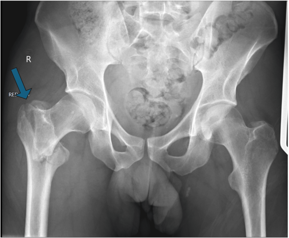 A Neck of Femur Fracture Associated With Electric Scooter Use in a ...