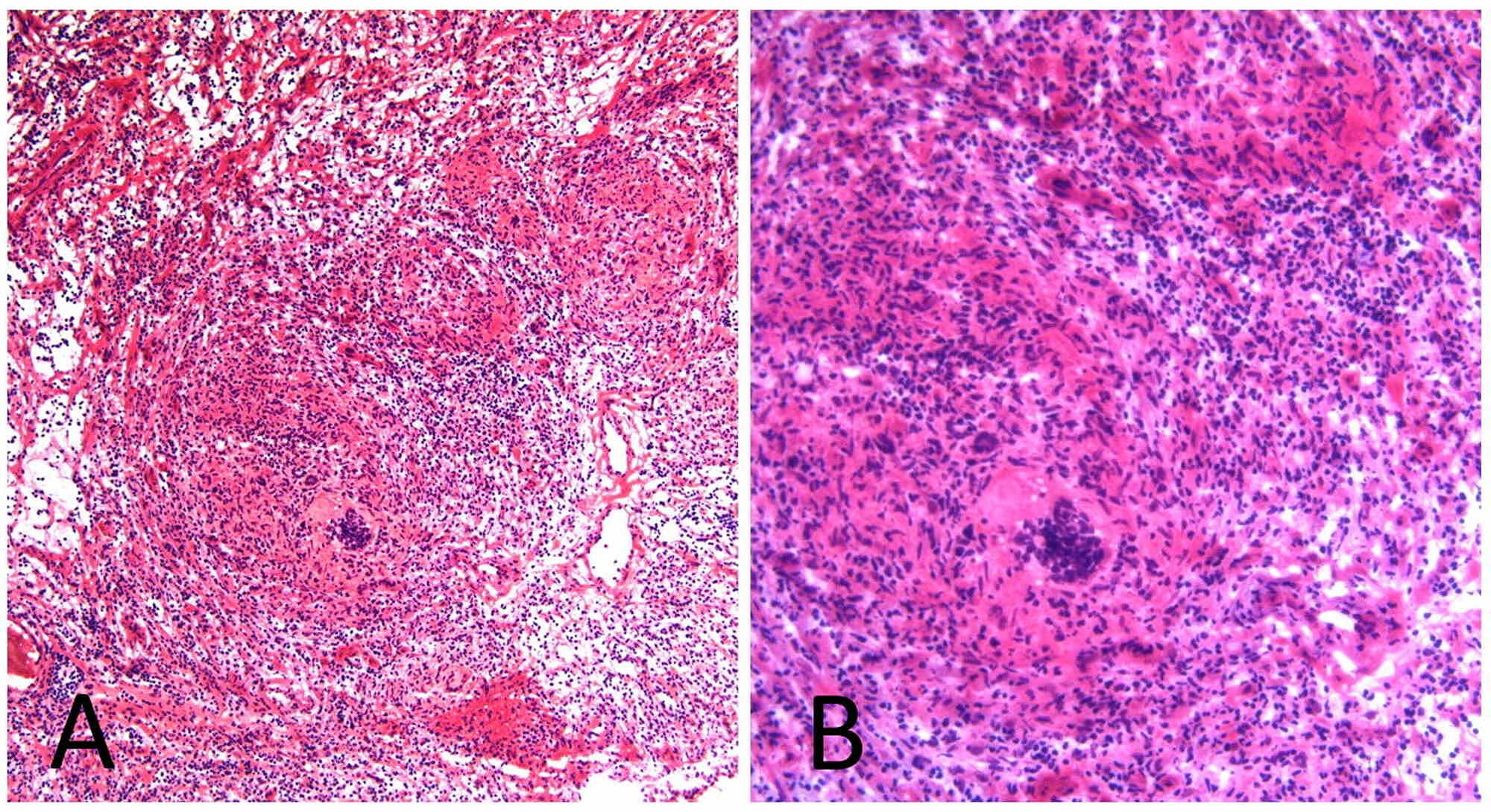 Cureus Testicular Sarcoidosis Diagnostic Approach And Management