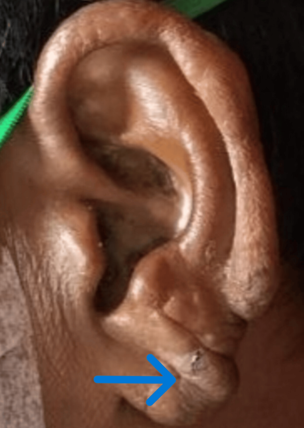 A Rare Cause of Pancytopenia From Lepromatous Leprosy Diagnosed in Bone ...