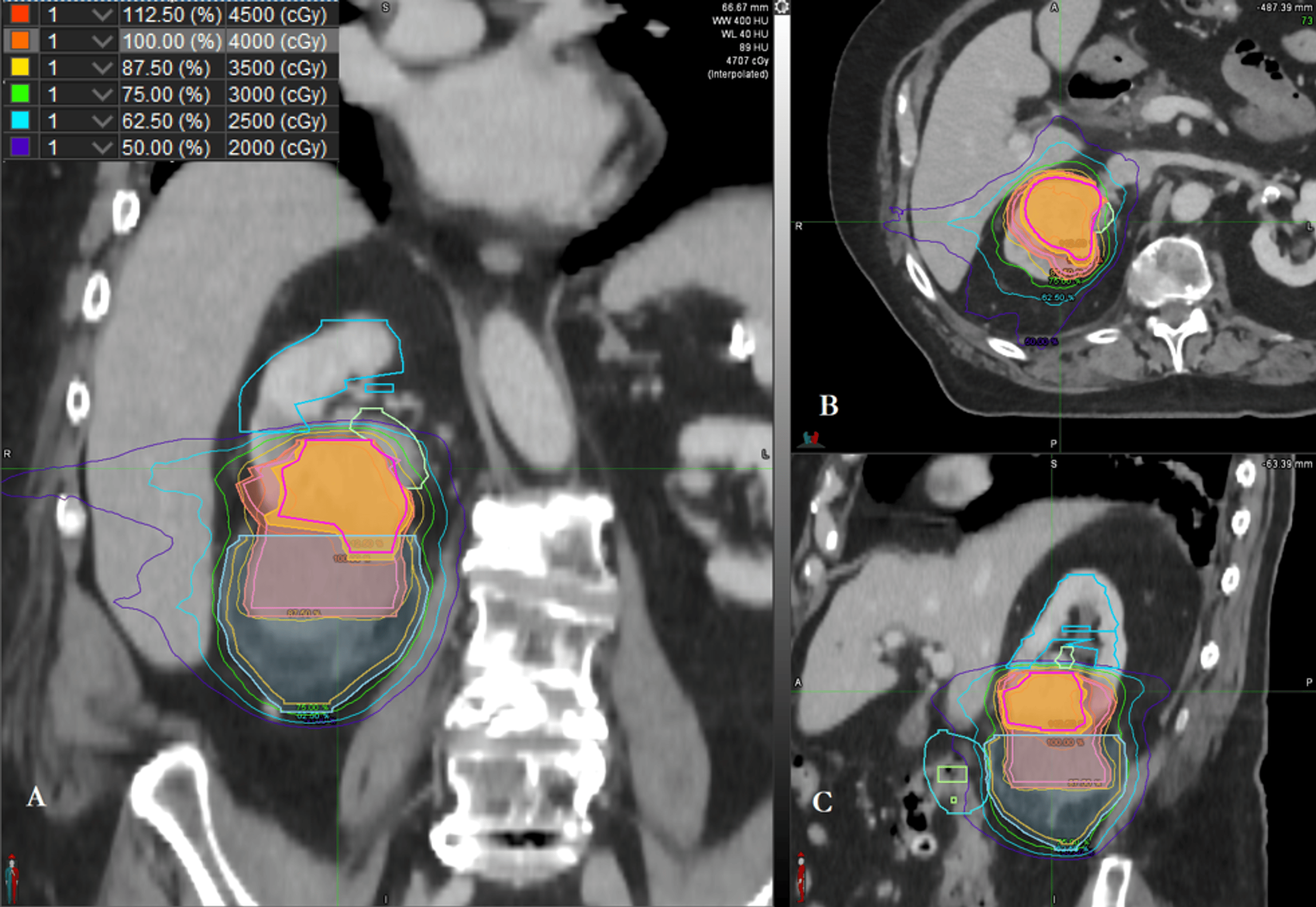 Durable Local Control With Preserved Renal Function for Stereotactic ...