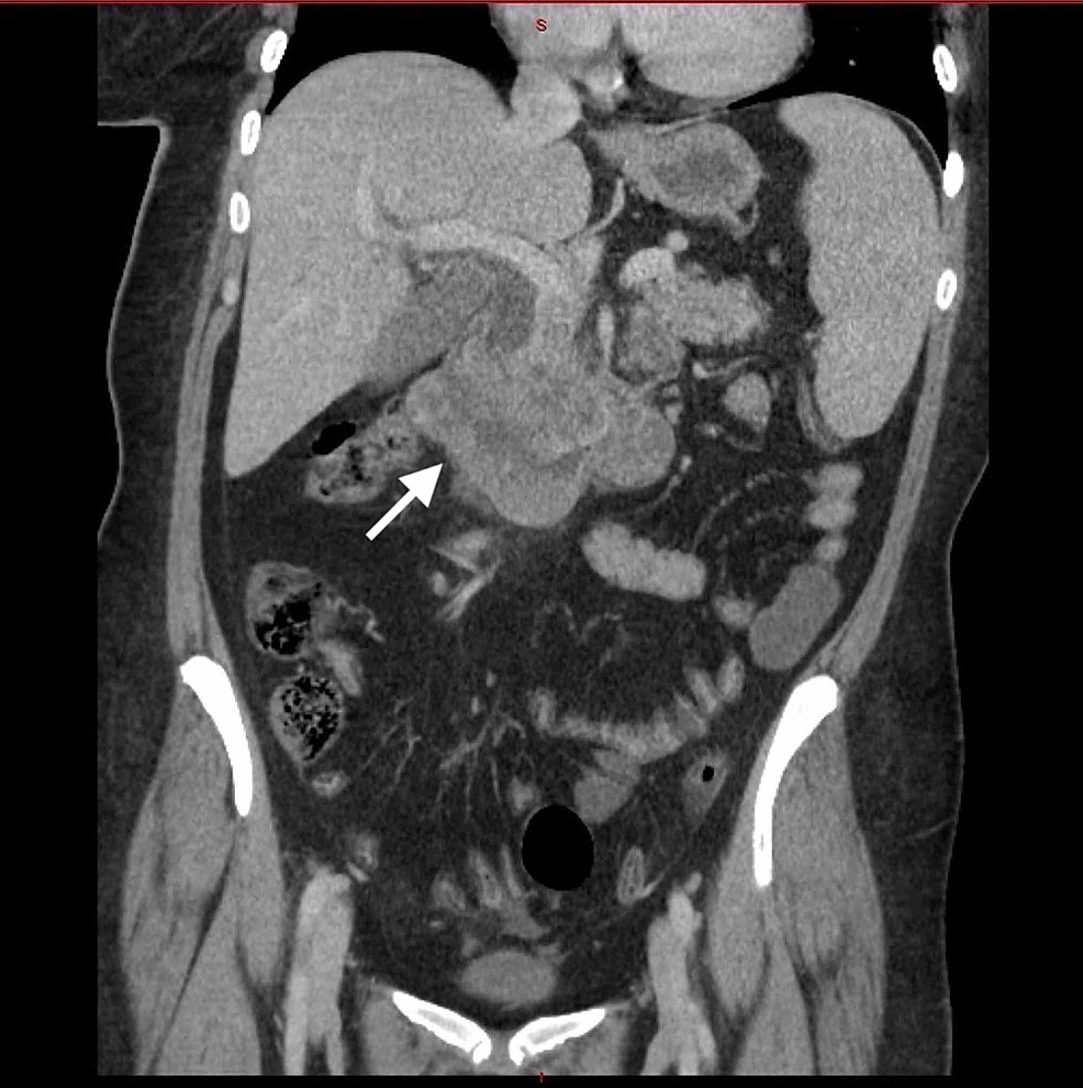 Cureus | Jaundice and Elevated Beta-Human Chorionic Gonadotropin in a ...