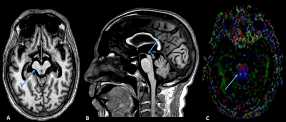 Precision Imaging in Neurodegeneration: The Superiority of Diffusion ...