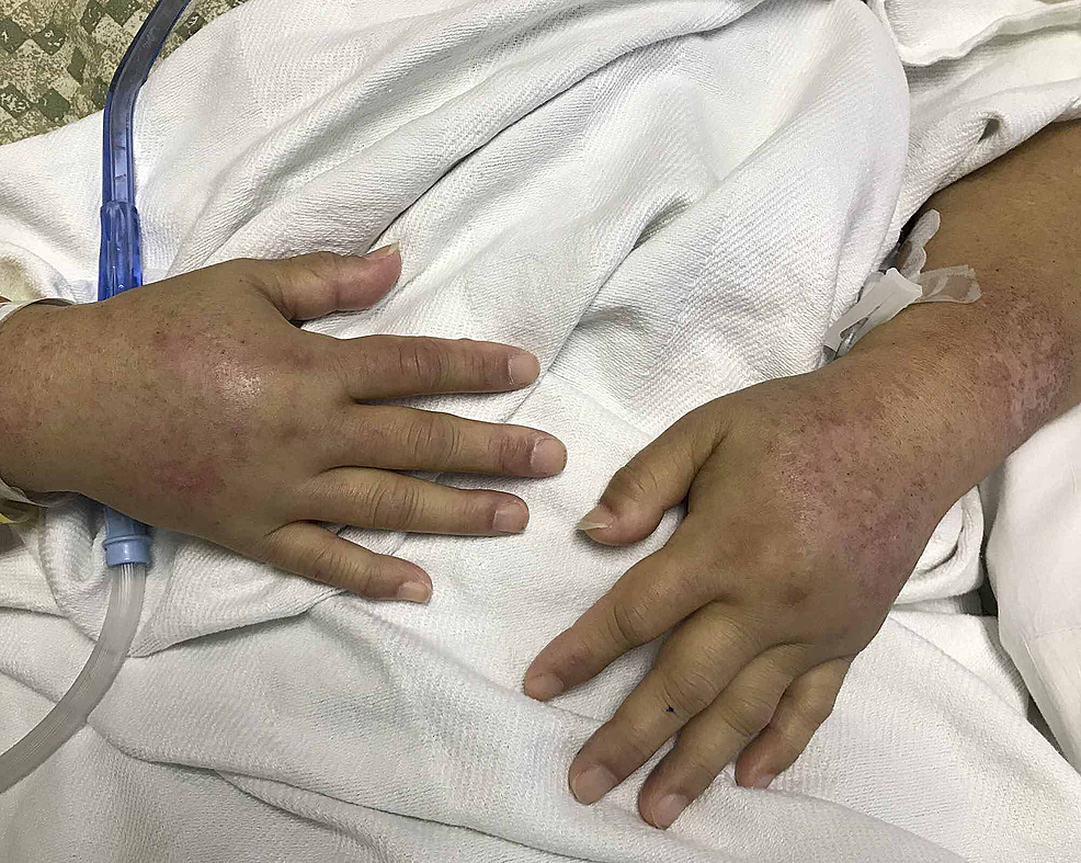 Cureus Unusual Bilateral Upper Extremity Pitting Edema In A Patient