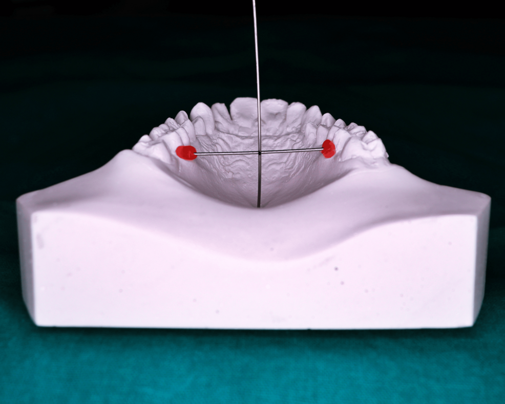 A Comparison of Arch Length, Intercanine Width, Intermolar Width, and ...