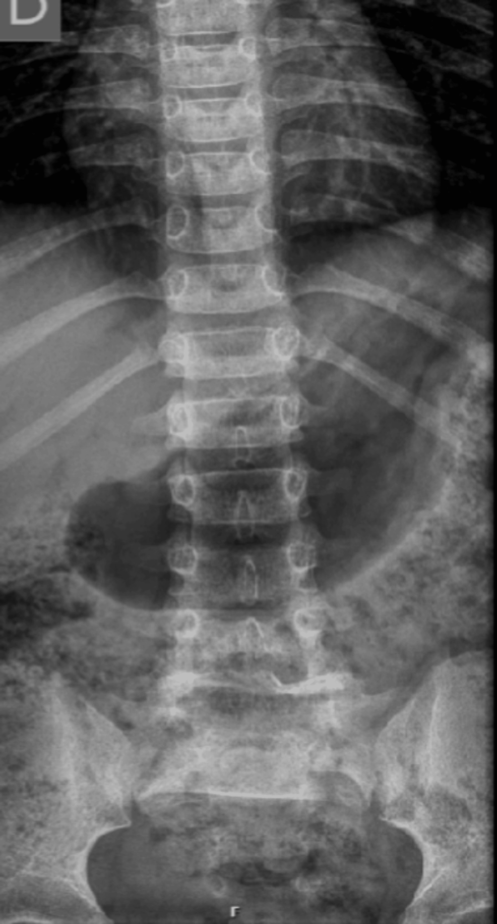 Traumatic Spondylolisthesis of L5-S1 in a Pediatric Age: A Rarely ...