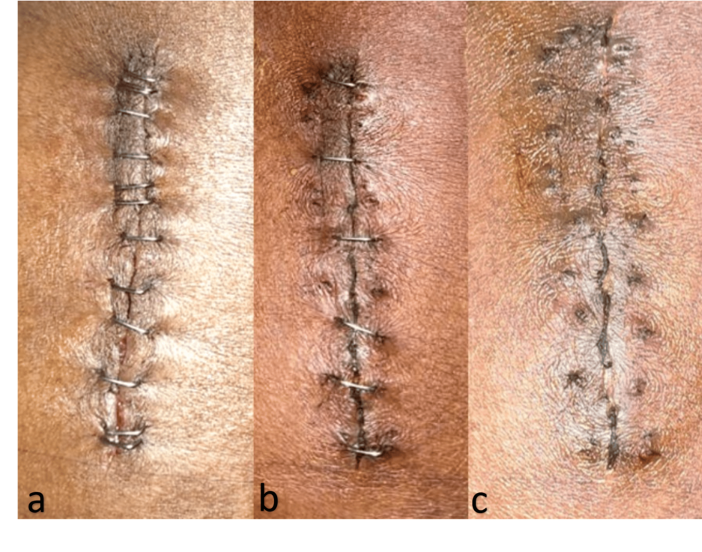 Orthopedic Skin Closure in South India: Sutures Versus Staples and ...