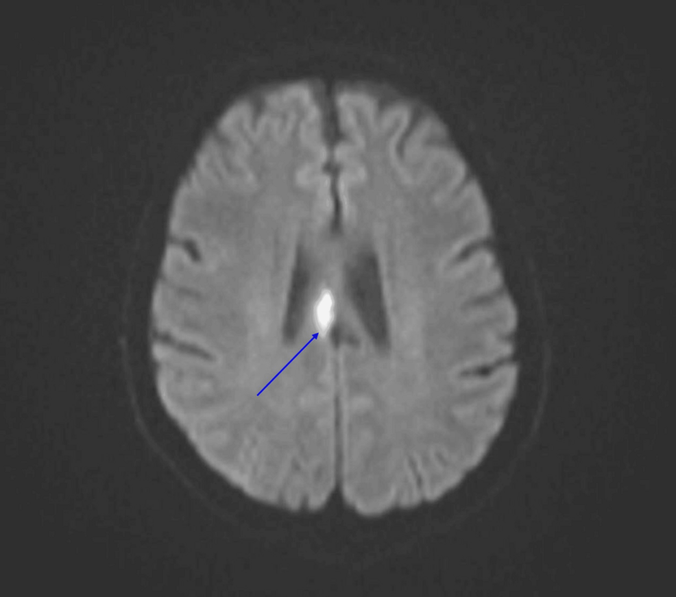 Corpus Callosum Infarct
