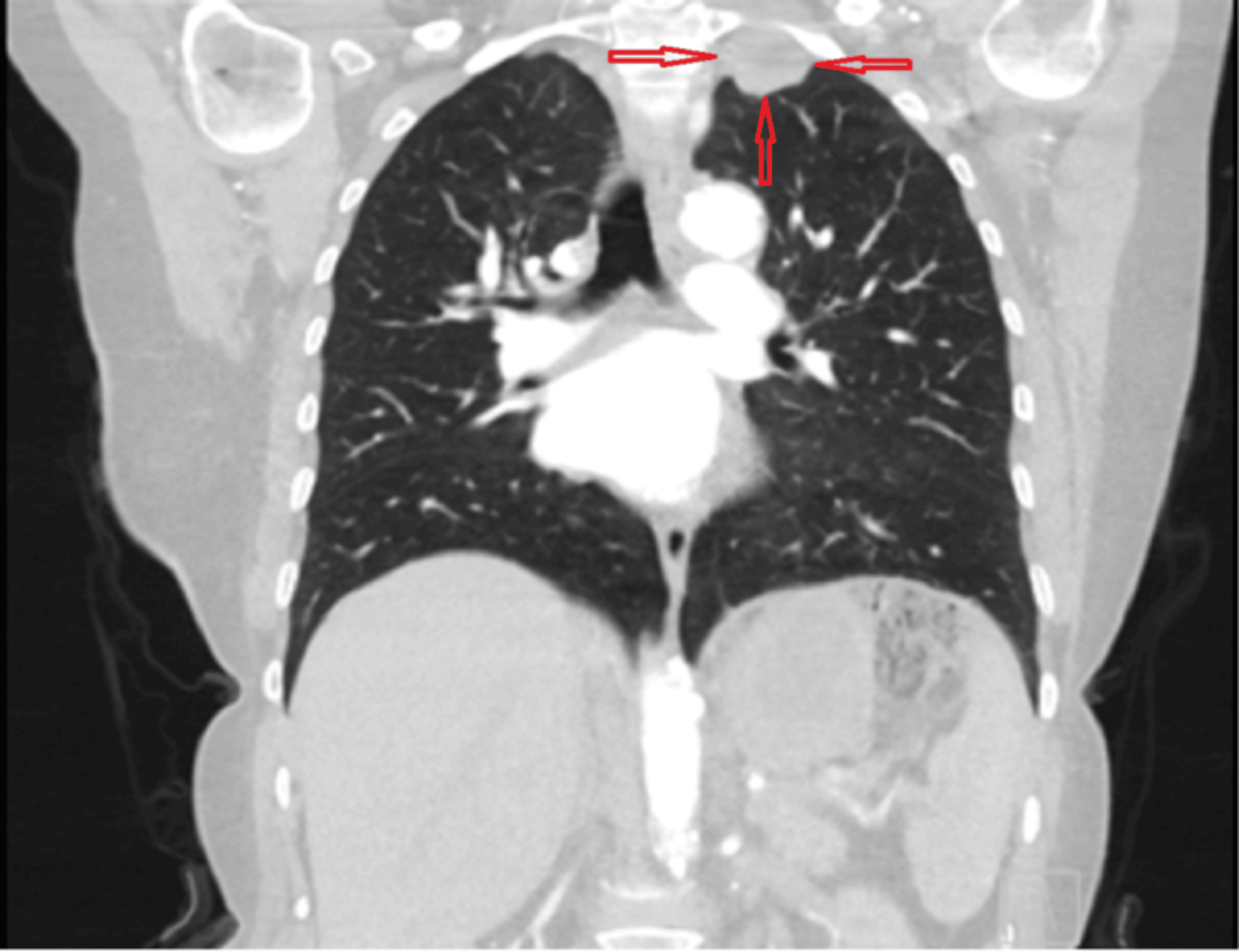 A Case of Brachial Plexus Schwannoma Intrathoracic Extension Guided via ...