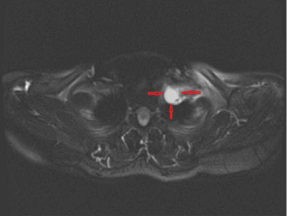 A Case of Brachial Plexus Schwannoma Intrathoracic Extension Guided via ...