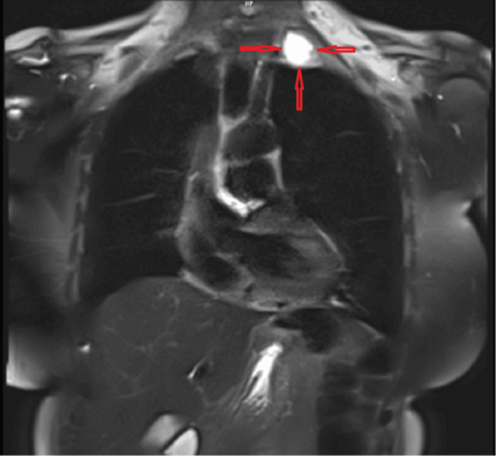 A Case of Brachial Plexus Schwannoma Intrathoracic Extension Guided via ...
