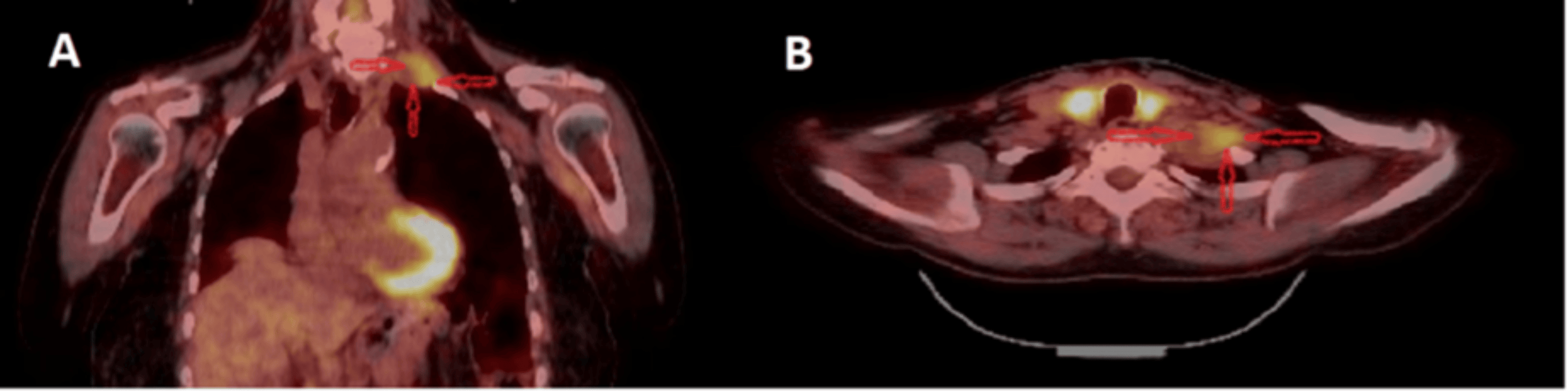 A Case of Brachial Plexus Schwannoma Intrathoracic Extension Guided via ...